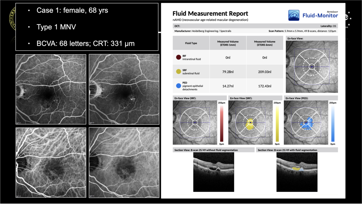 Fluid monitor in neovascular age-related macular degeneration: a case ...